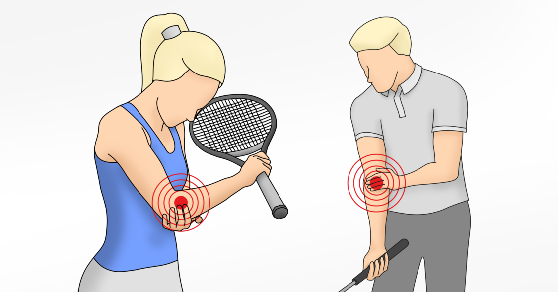 Tennis and Golfer's Elbow: What Causes Them and How to Get Rid of Them ...